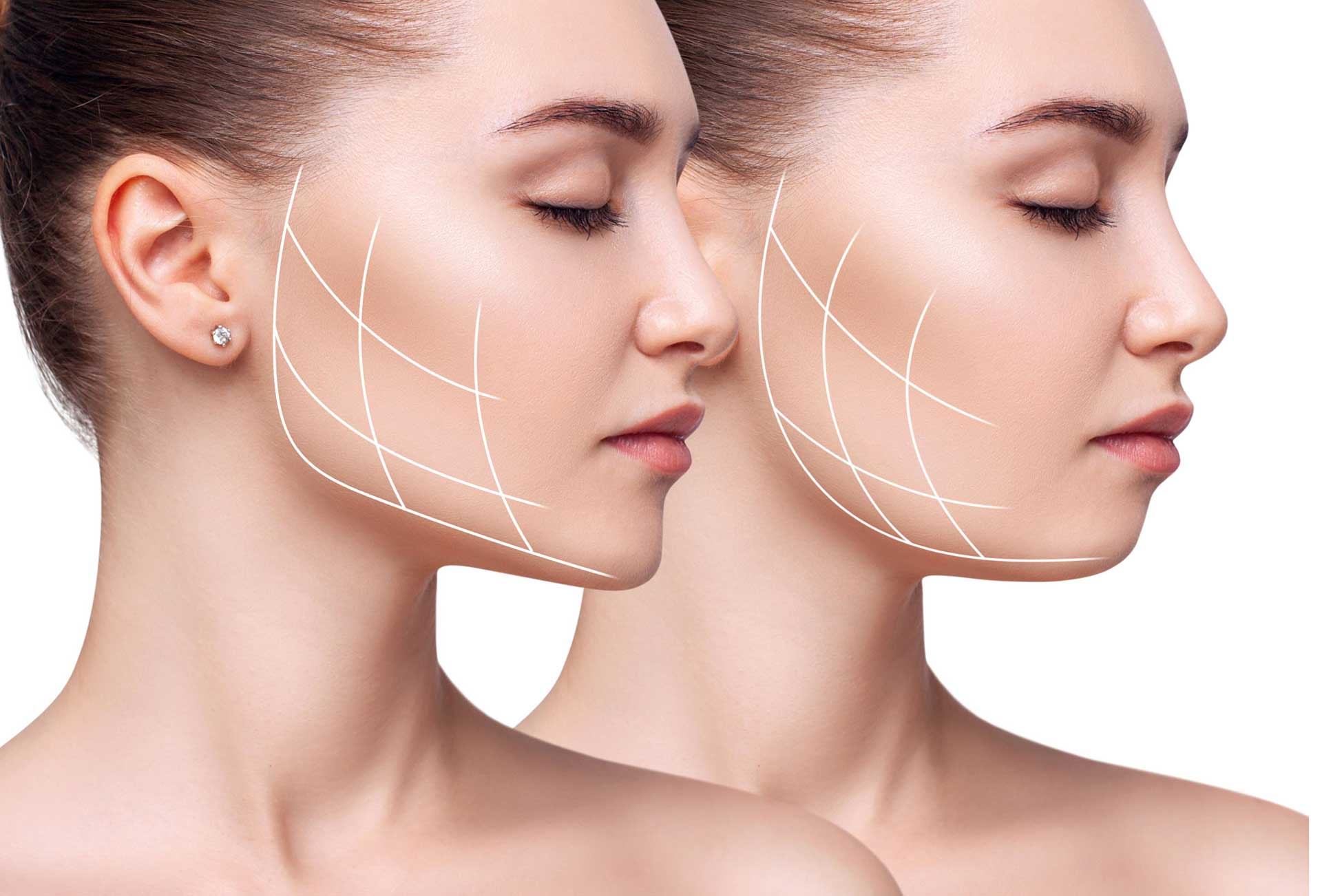 KYBELLA® in Gainesville, GA | Medical Aesthetics at Guilford